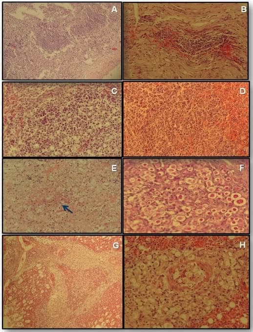 Una nueva asociación: histomoniasis sistémica ocasionada por enfermedad ...