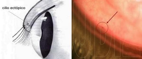 DISTRIQUIASIS Y CILIOS ECTÓPICOS | Engormix
