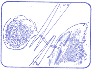 Técnicas de castración del cerdo | Engormix